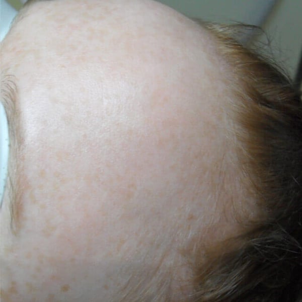 Hyperpigmentation | The Hampton Clinic